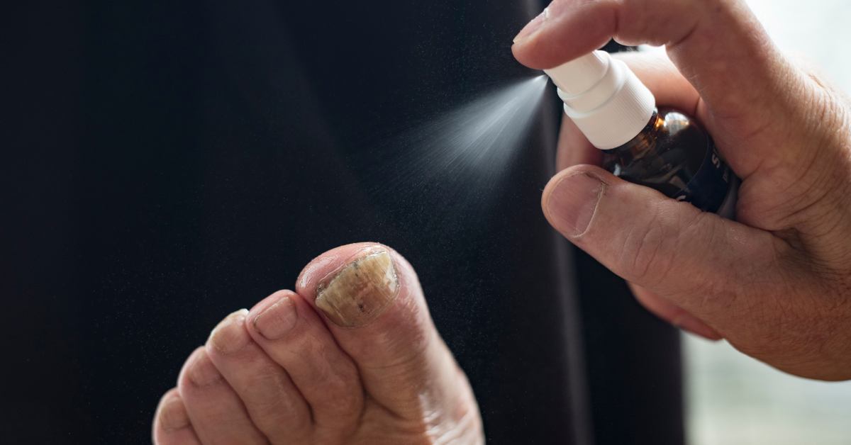 Atletsko stopalo (Tinea pedis): simptomi, uzroci i lek - Stopalin